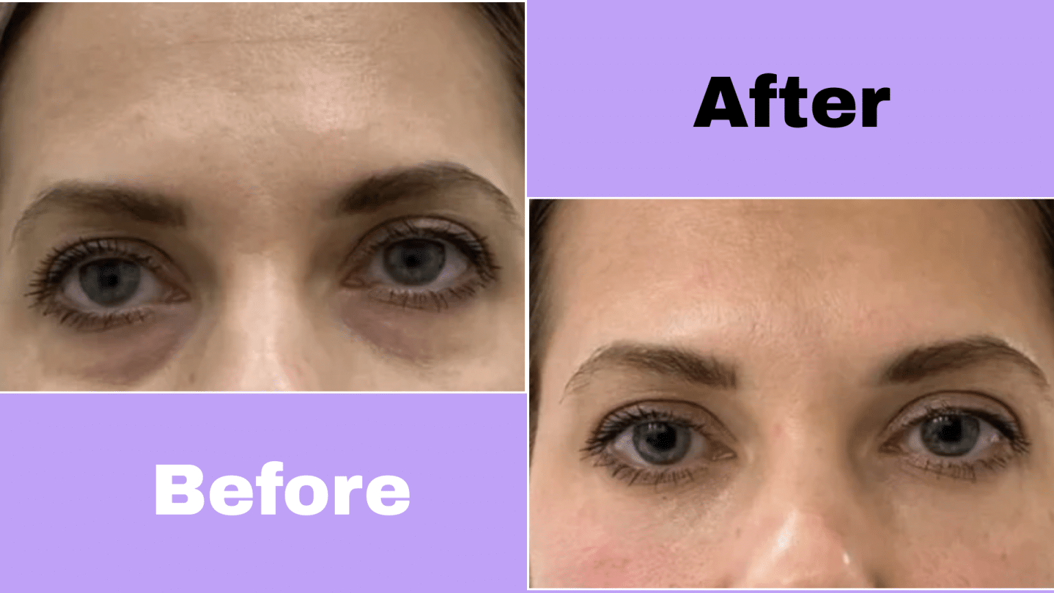 What is PRP Under Eyes? Benefits, Side Effects and Procedure ...