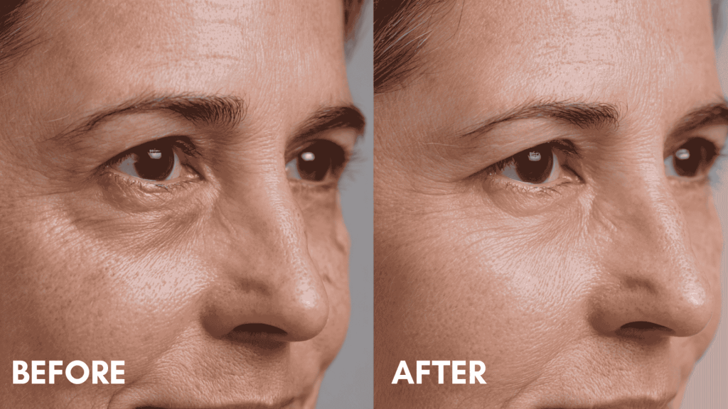 PRP Under Eyes Before and After: See the Difference - Typically Jane